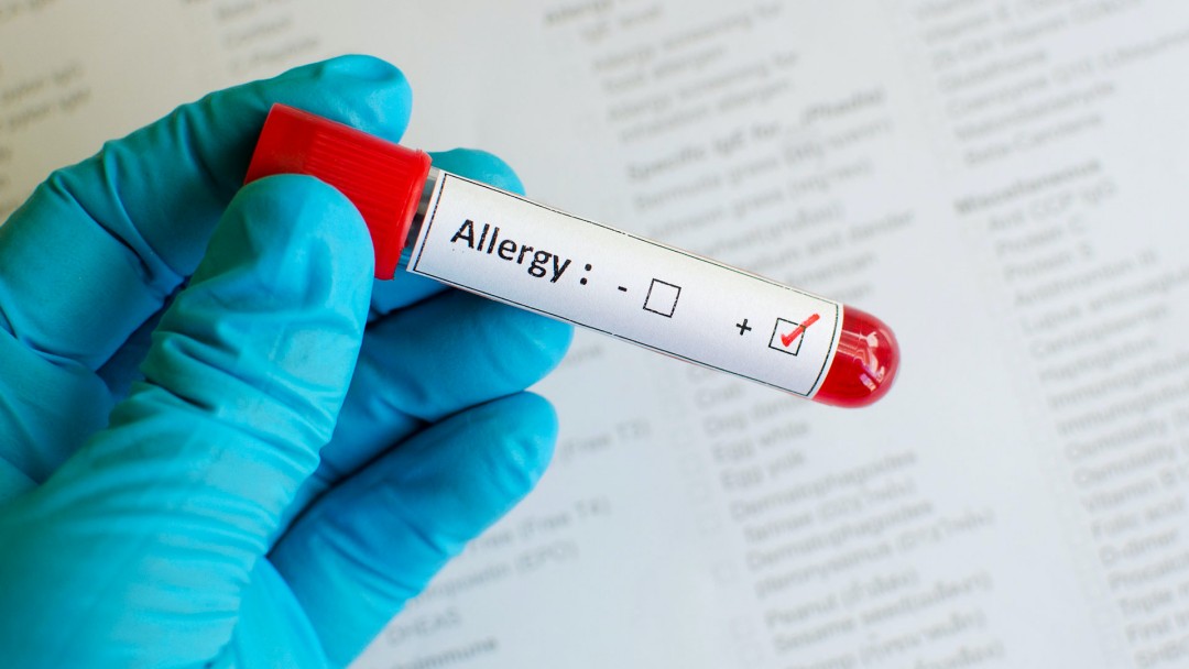 REGENE’s IgE Allergy Test: A Modern Solution